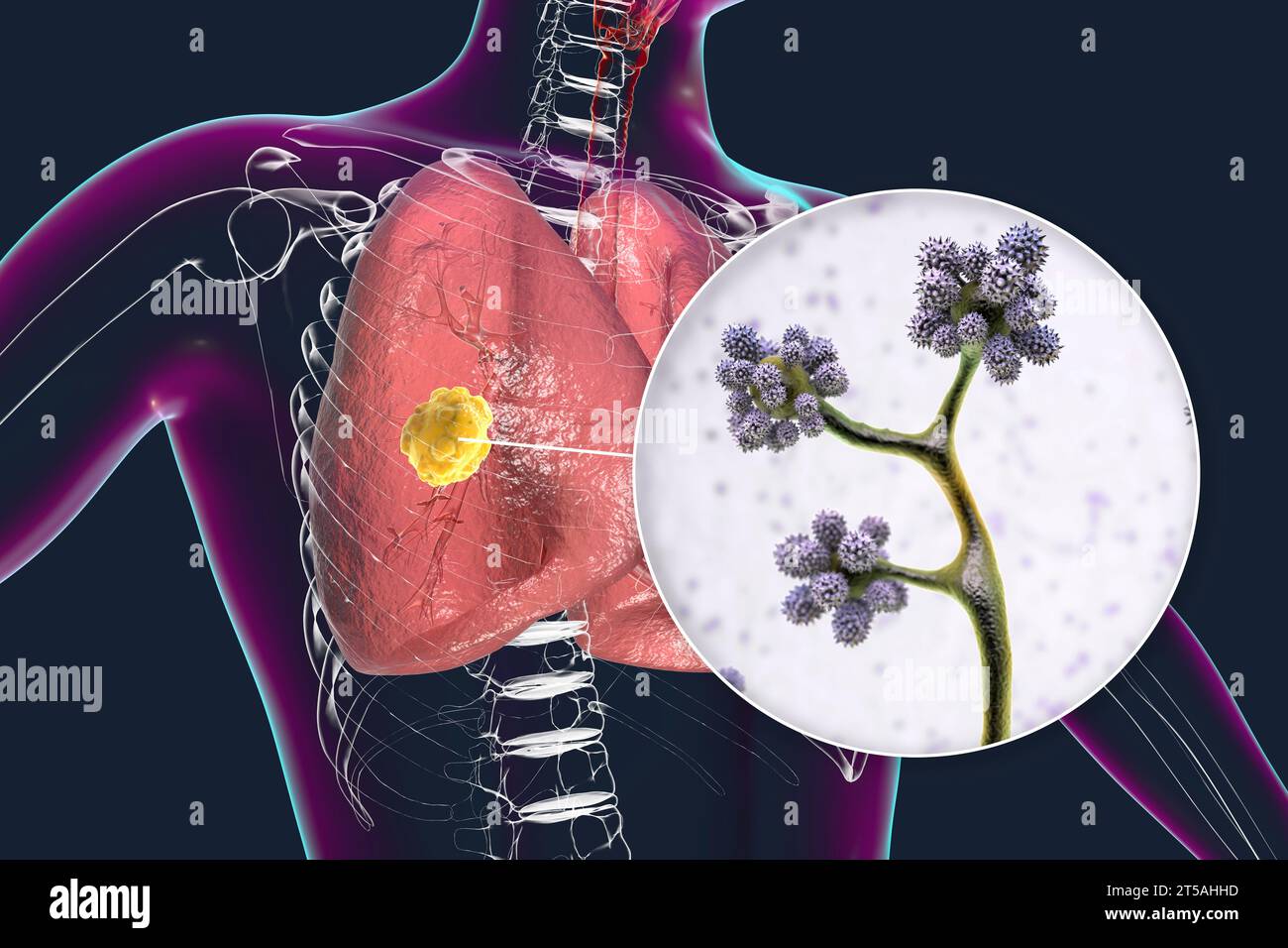 Mucormycose pulmonaire Banque de photographies et d’images à haute résolution - Alamy