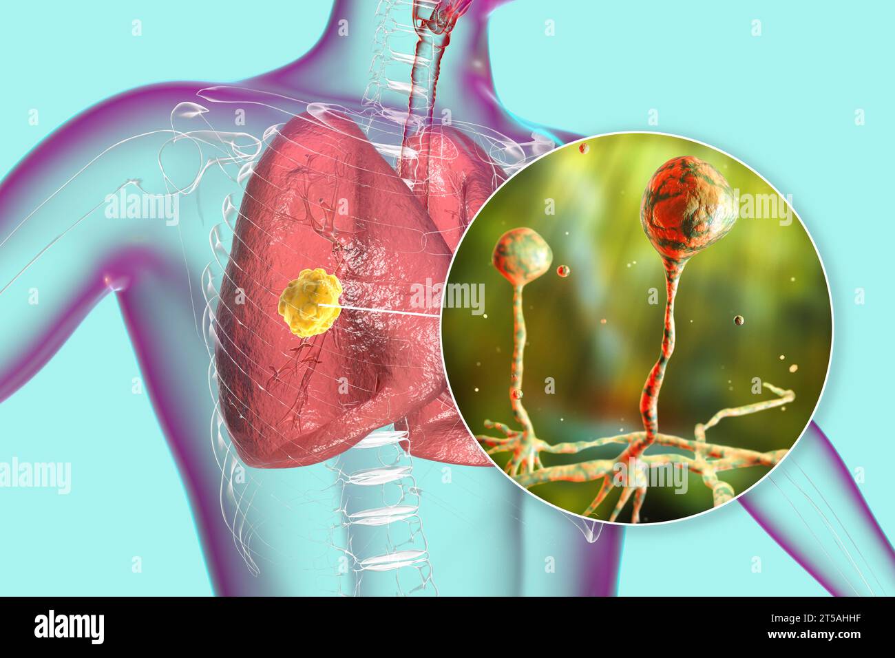 Mucormycose pulmonaire Banque de photographies et d’images à haute résolution - Alamy