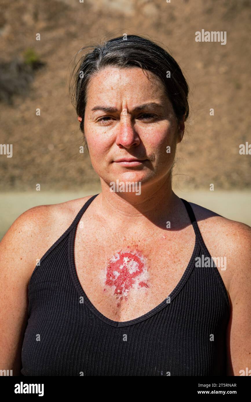 Carcinome basocellulaire superficiel Banque de photographies et d ...