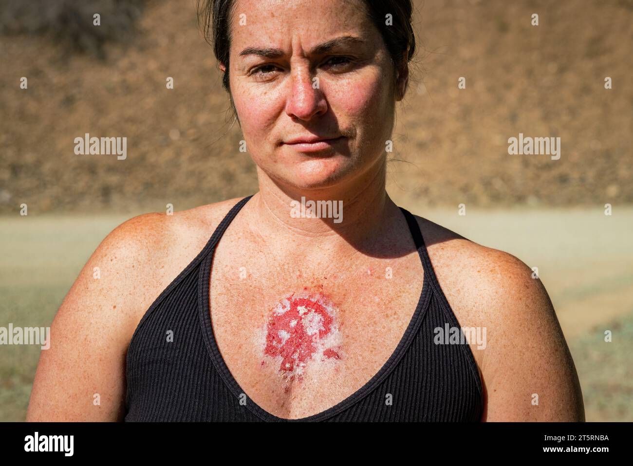 Carcinome basocellulaire superficiel Banque de photographies et d ...