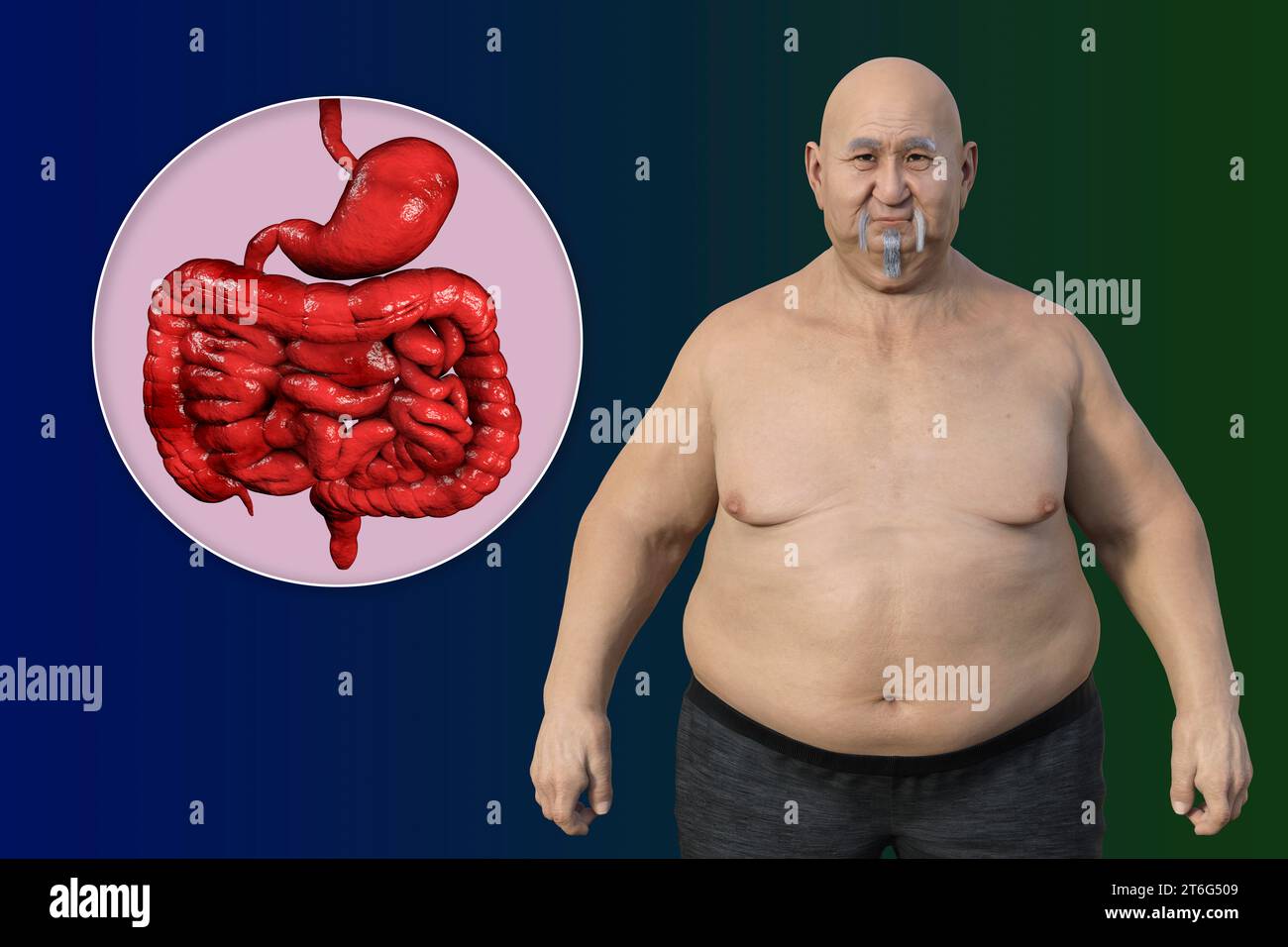 Une illustration médicale détaillée en 3D d'un homme en surpoids à la ...