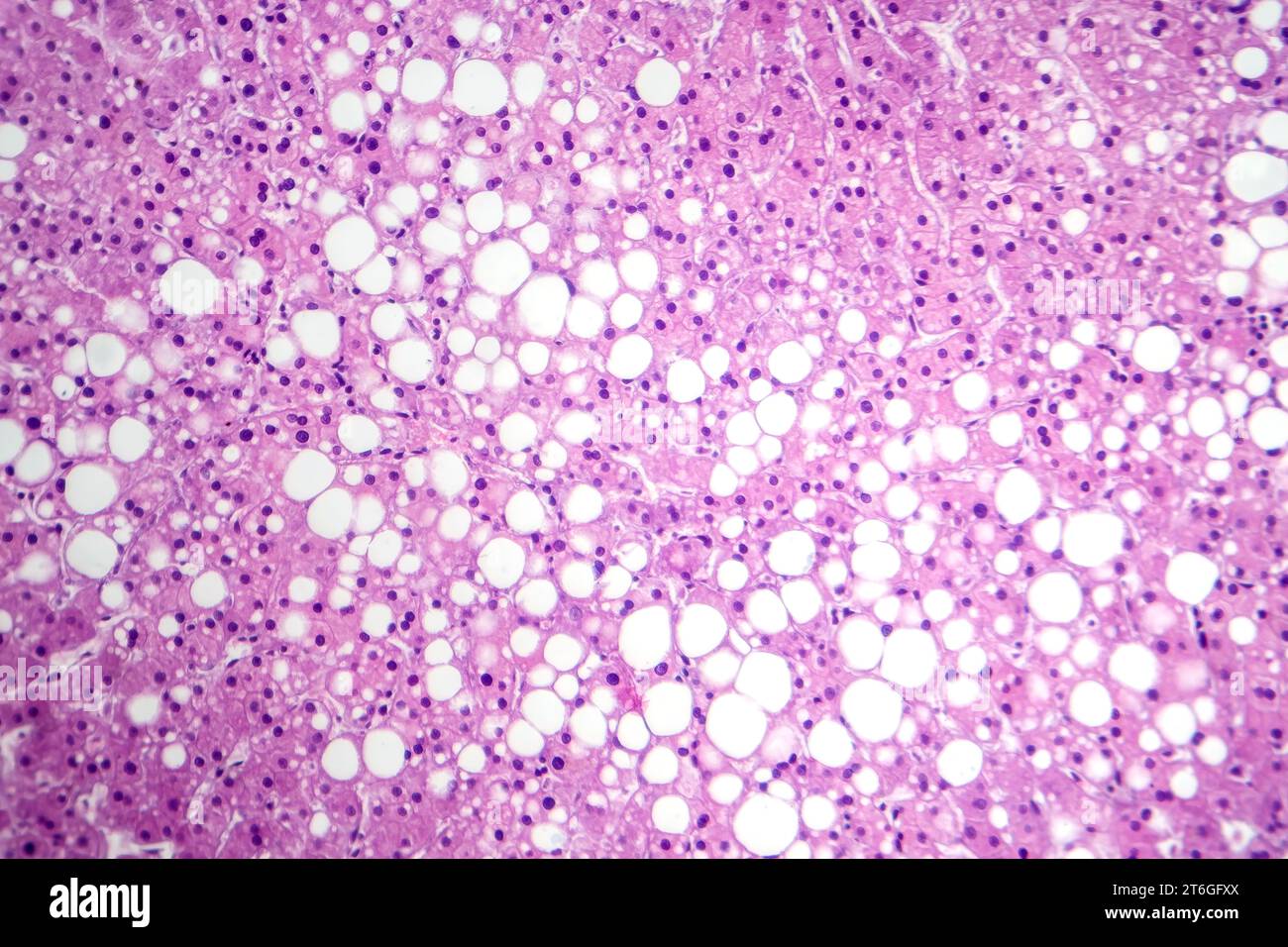 Photomicrographie de la stéatose hépatique, révélant une accumulation ...