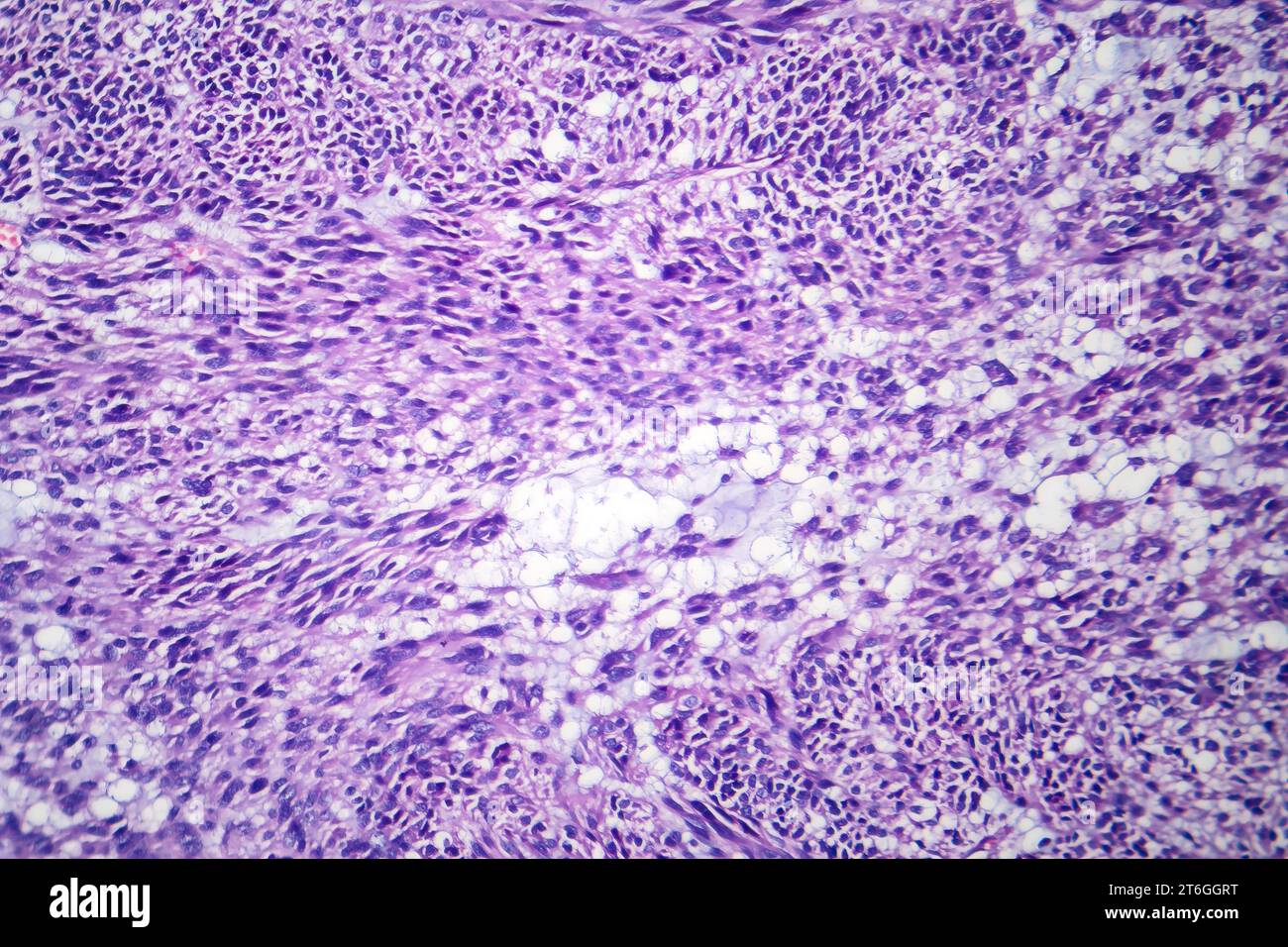 Photomicrographie d'un léiomyome, illustrant les cellules tumorales ...