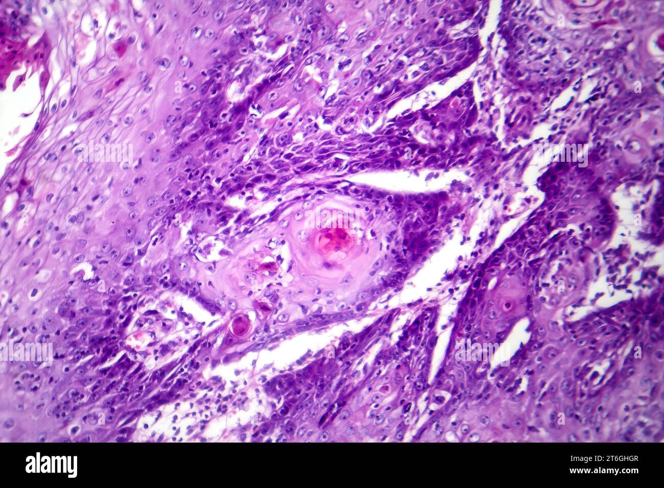 Photomicrographie d'un carcinome épidermoïde cutané, représentant des cellules épidermiques ...