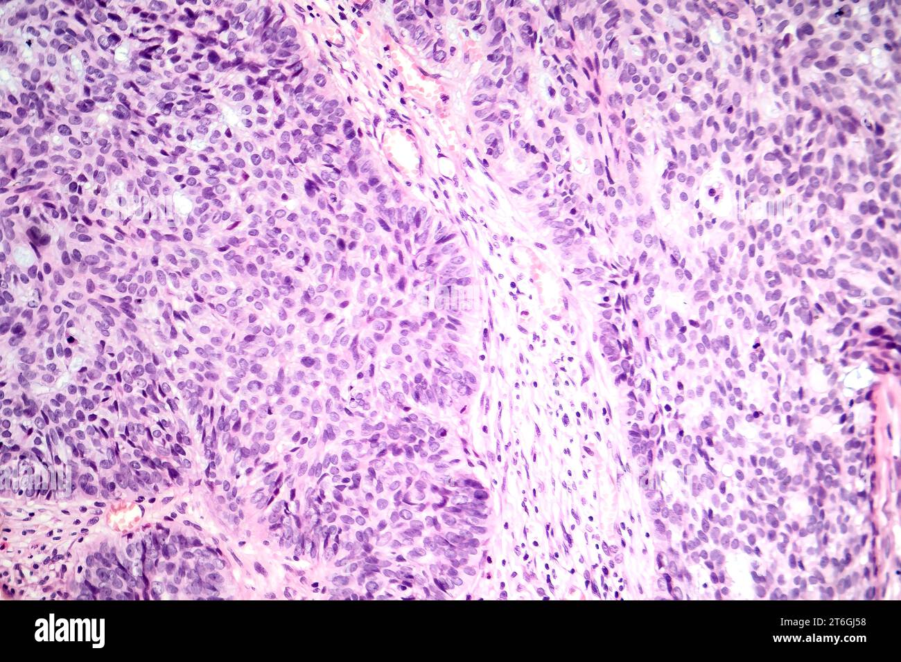 Photomicrographie du carcinome basocellulaire, montrant les cellules ...