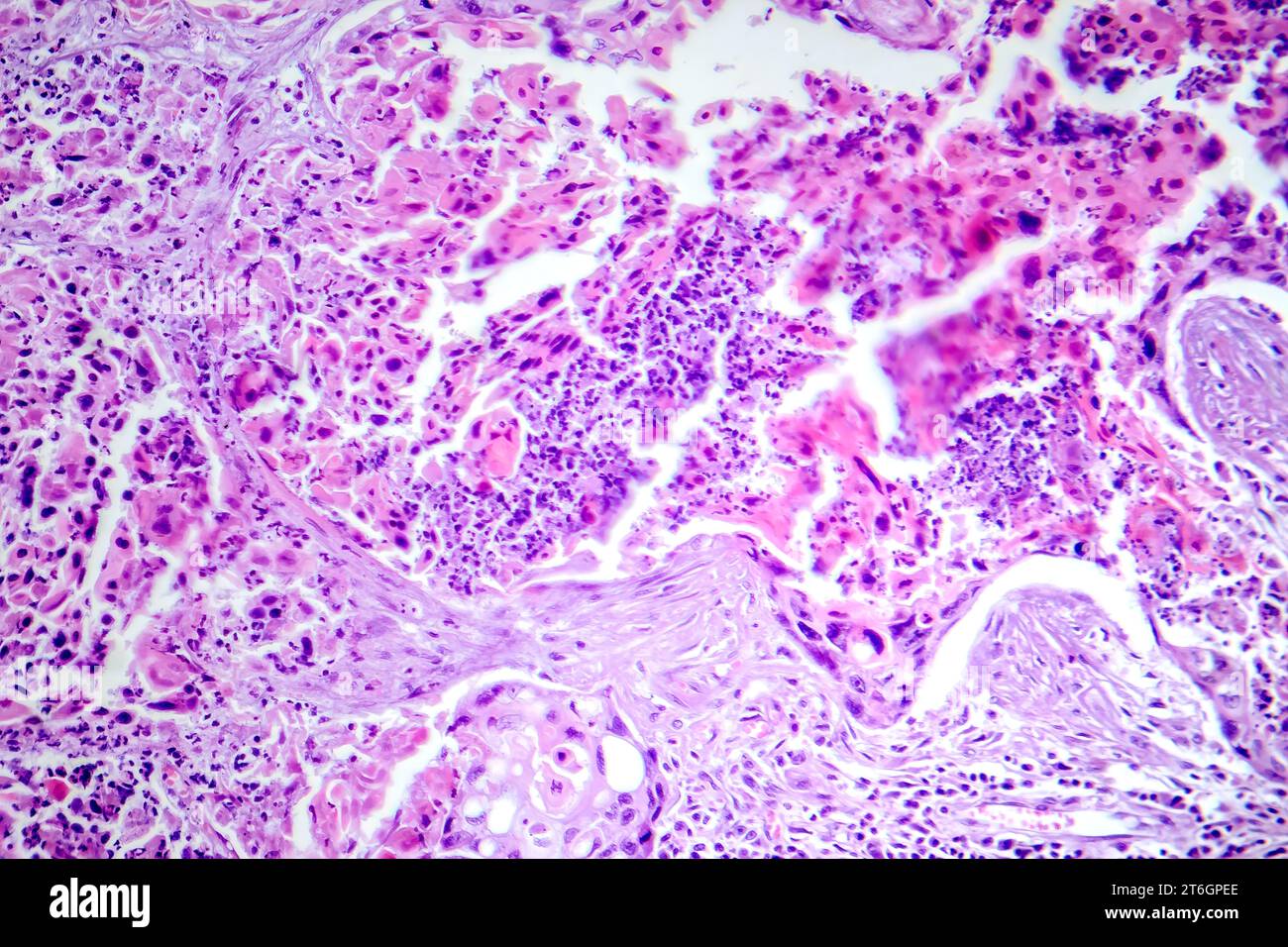 Carcinome épidermoïde histologie Banque de photographies et d’images à ...