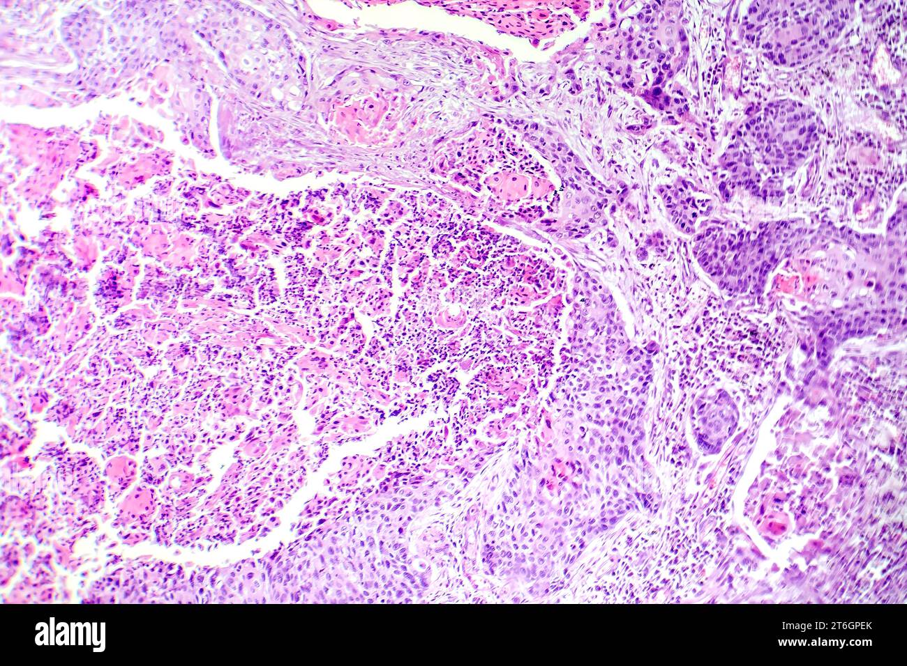 Photomicrographie d'un carcinome épidermoïde du poumon, montrant des cellules squameuses ...