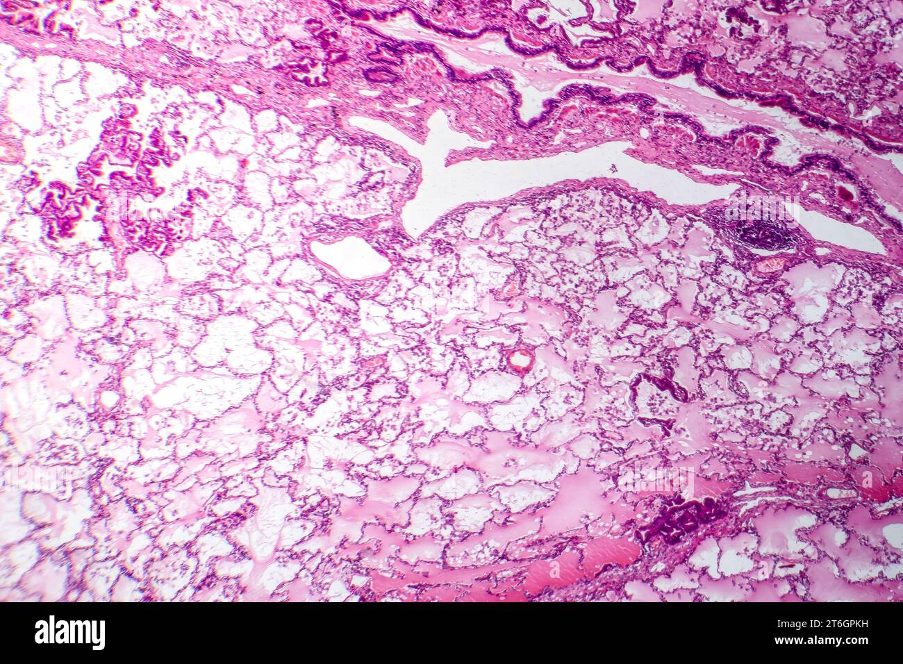 Photomicrographie d'adénocarcinome pulmonaire, montrant des cellules ...