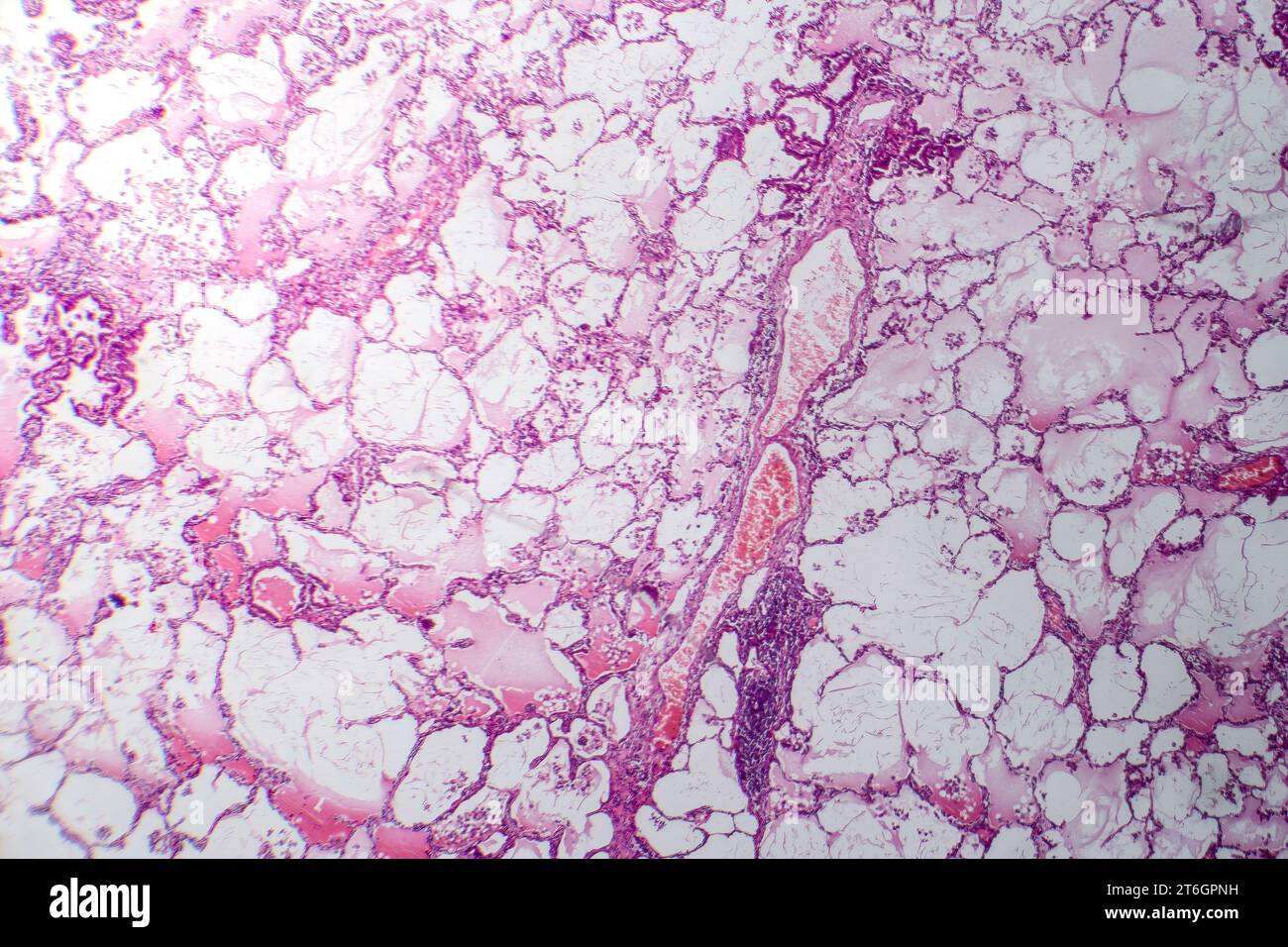 Photomicrographie d'adénocarcinome pulmonaire, montrant des cellules ...