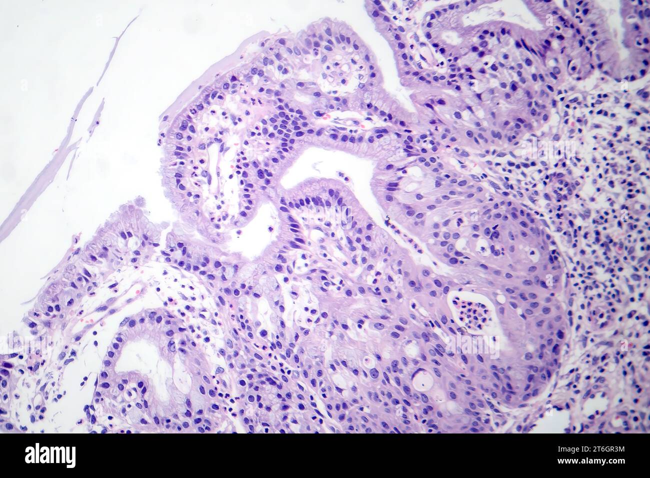 Photomicrographie des polypes nasaux, montrant une croissance anormale des tissus dans les voies ...