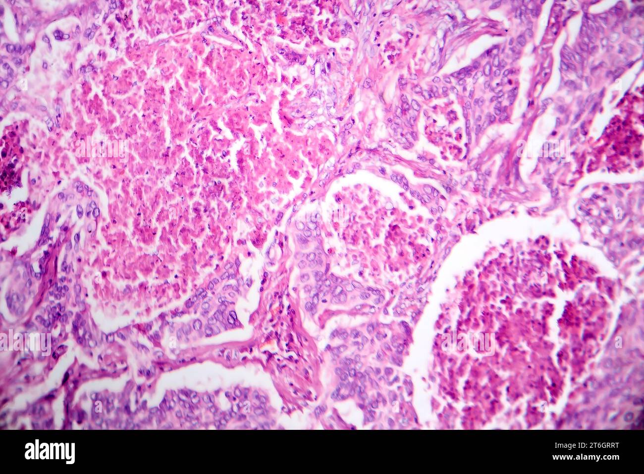 Photomicrographie d'adénocarcinome pulmonaire illustrant les cellules ...