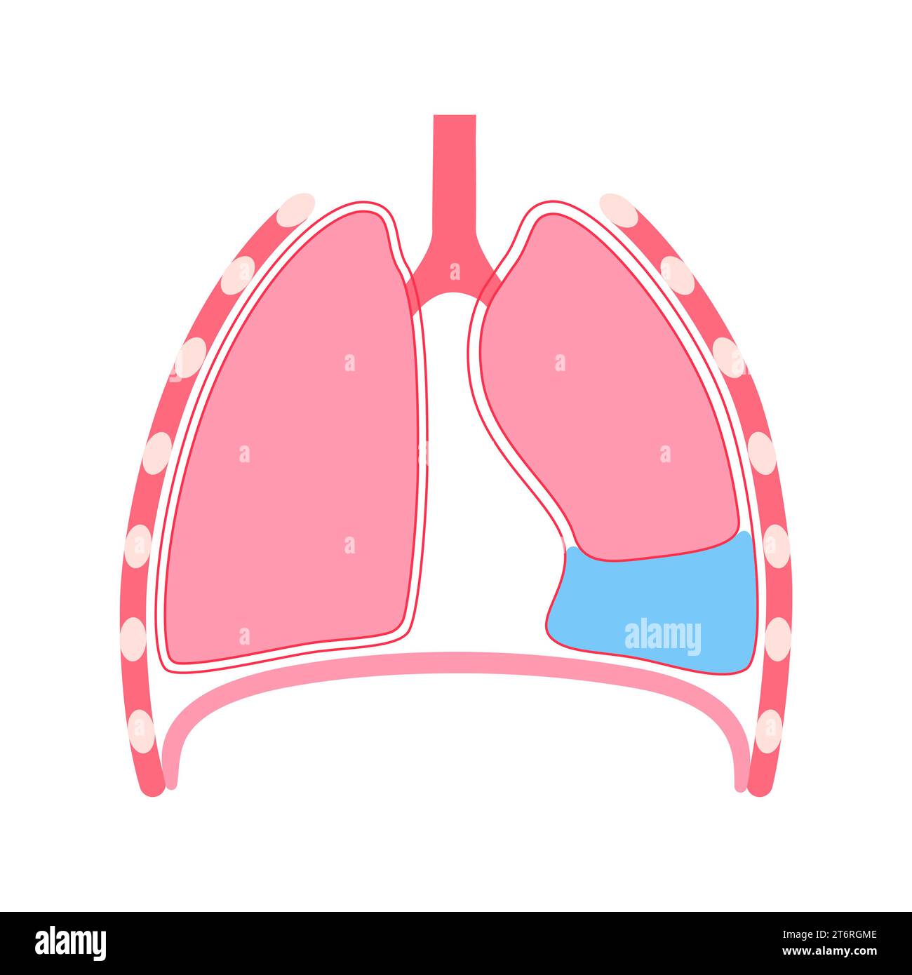 Pleural effusion Banque d'images détourées - Alamy
