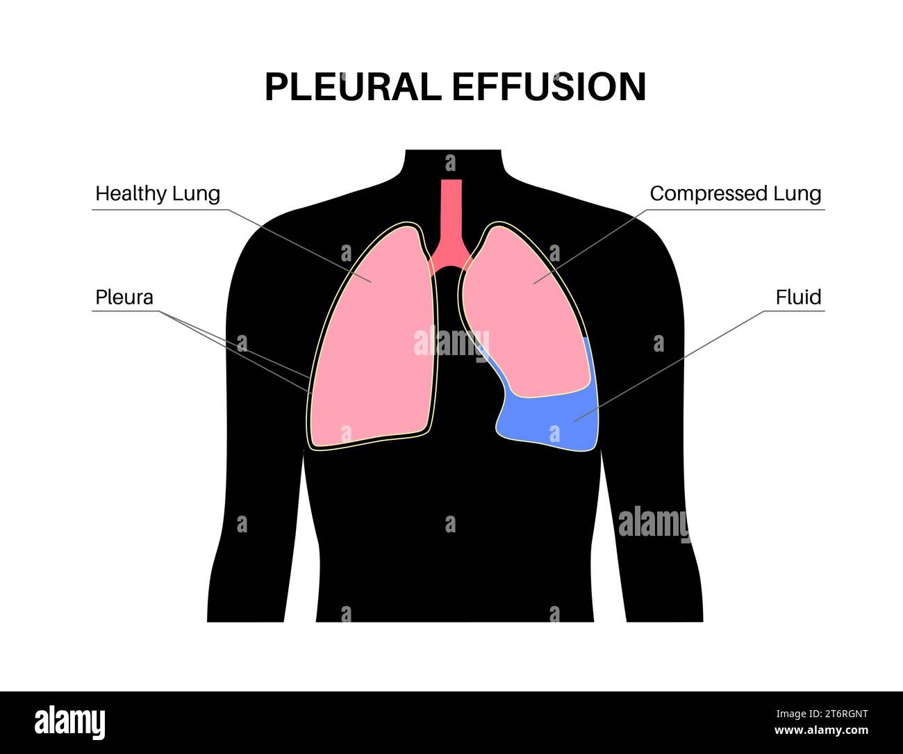 Pleural effusion Banque d'images détourées - Alamy