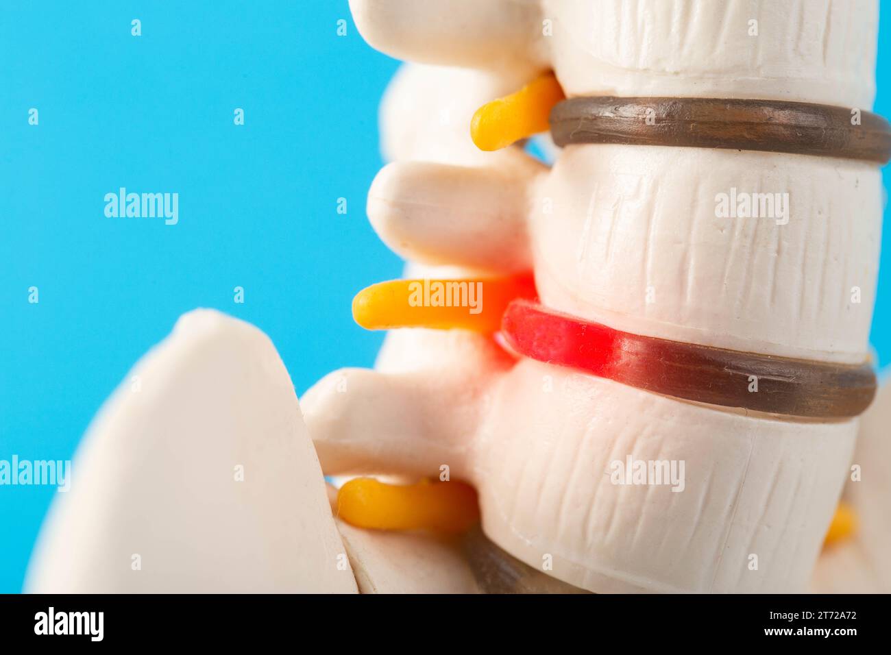 Hernie discale intervertébrale enflammée rouge sur un modèle médical de ...