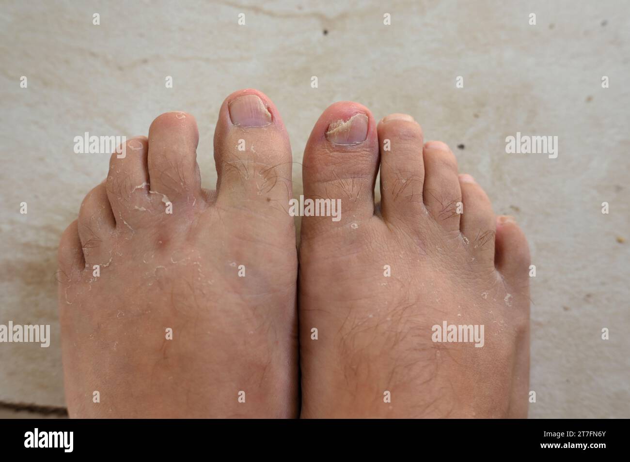 Infection fongique par teigne des ongles du gros orteil. Infection ...