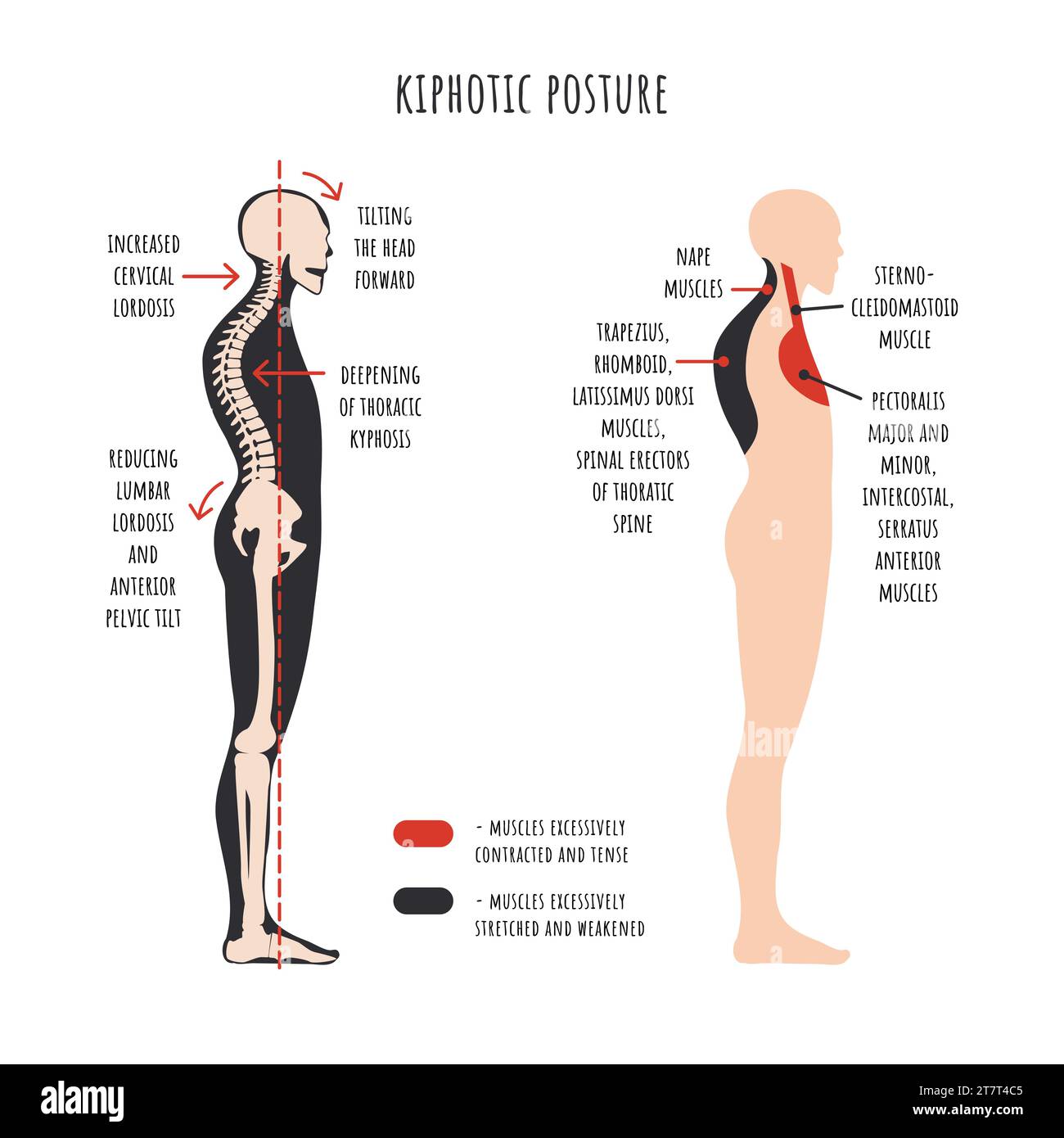 Infographie des troubles posturaux. Posture cyphotique. La vue latérale ...