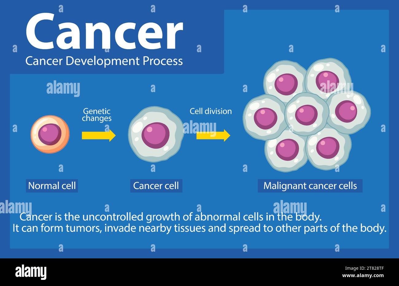 Comprendre le développement et la progression des cellules cancéreuses à travers une infographie ...