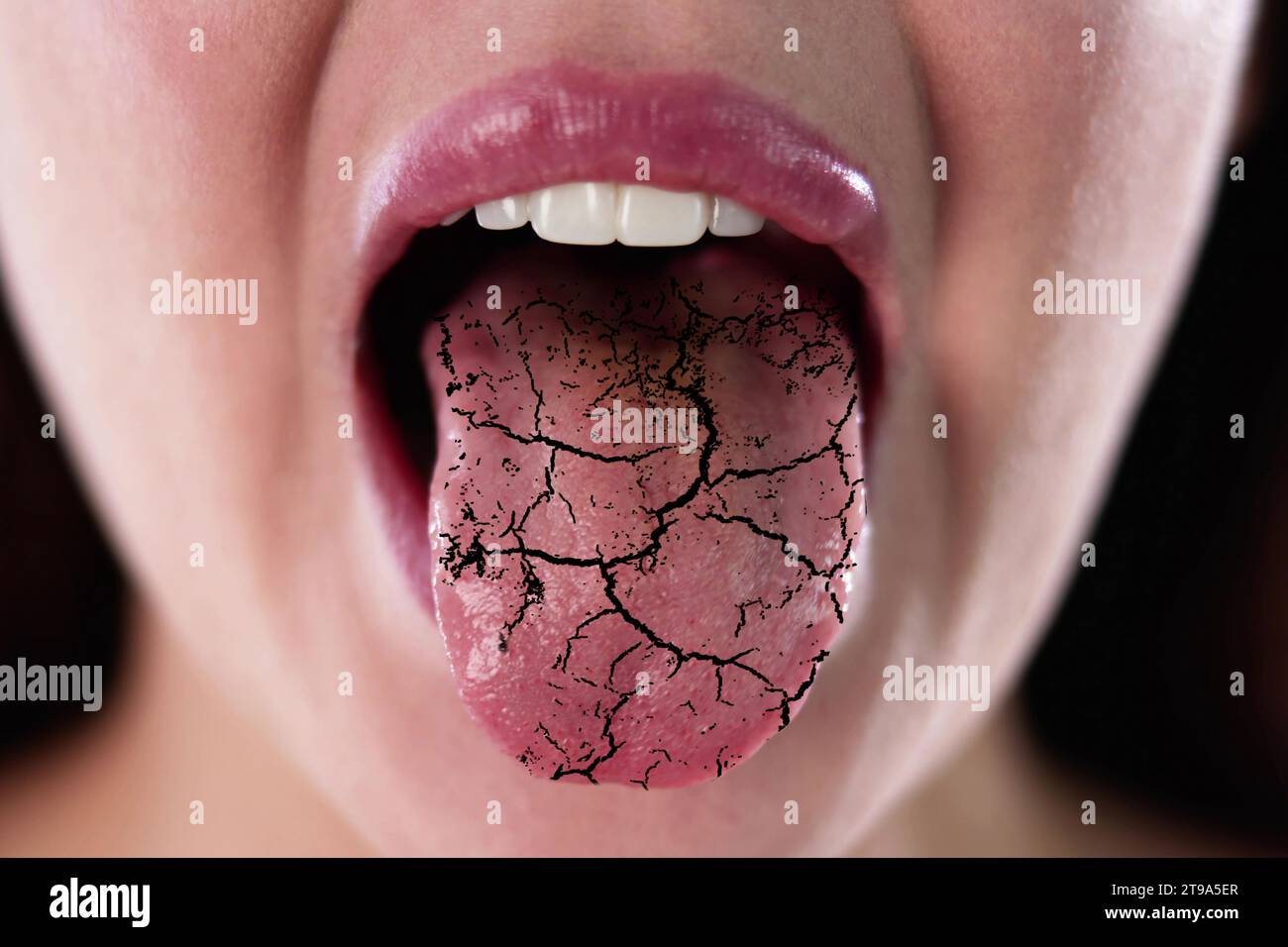 Aphtes langue Banque de photographies et d’images à haute résolution ...