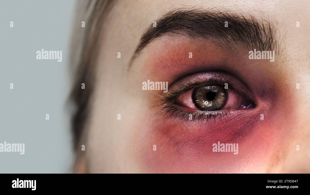 Hémorragie sous conjonctivale Banque de photographies et d’images à ...