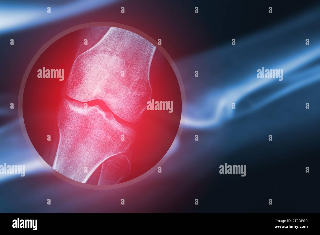 Bursite du genou Banque de photographies et d’images à haute résolution ...