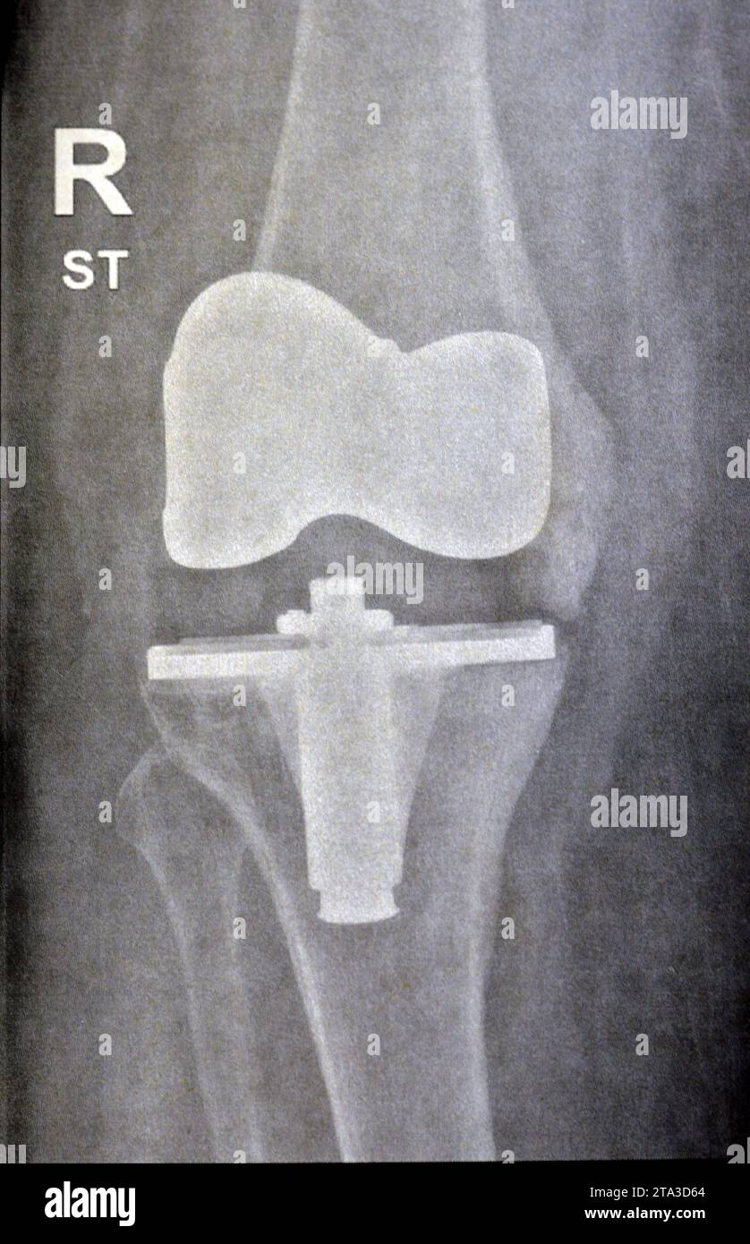 Radiographie simple montrant une arthroplastie totale de remplacement ...