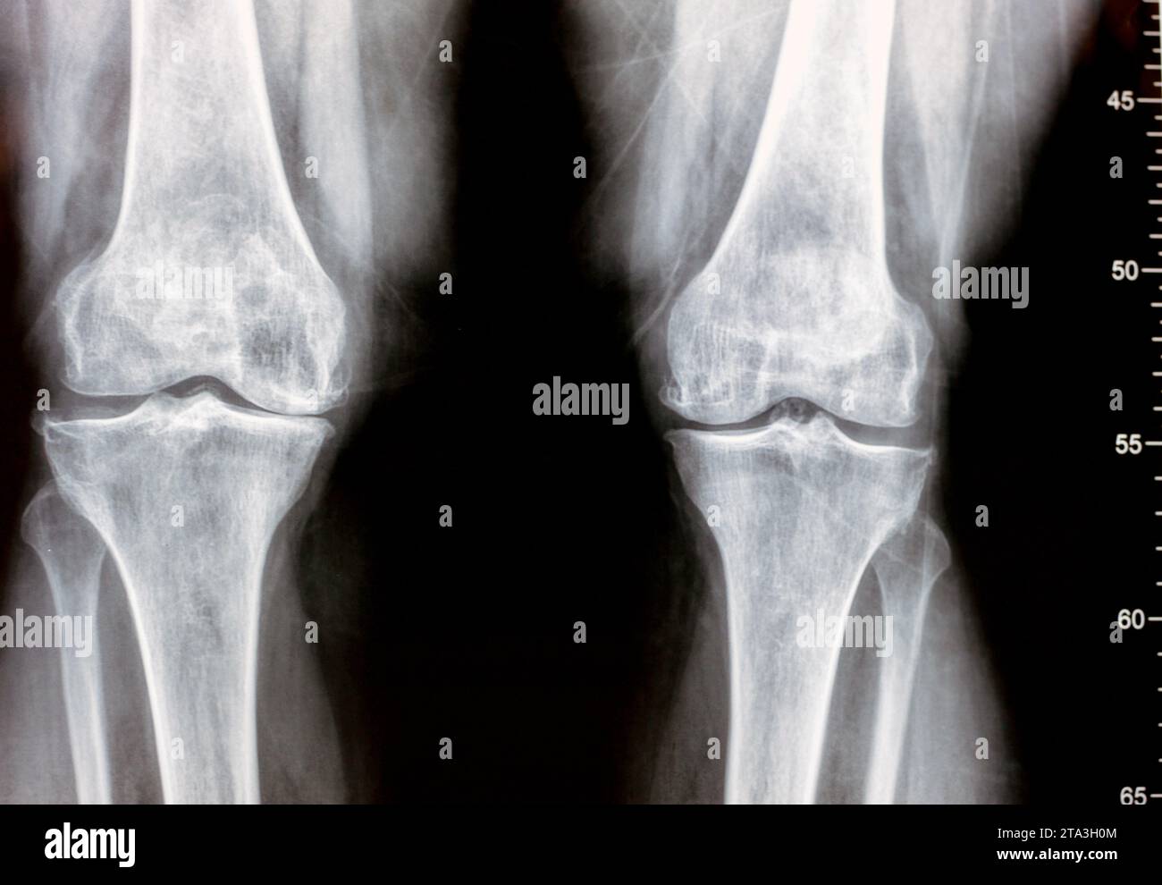 La radiographie simple des deux articulations du genou montre une ...