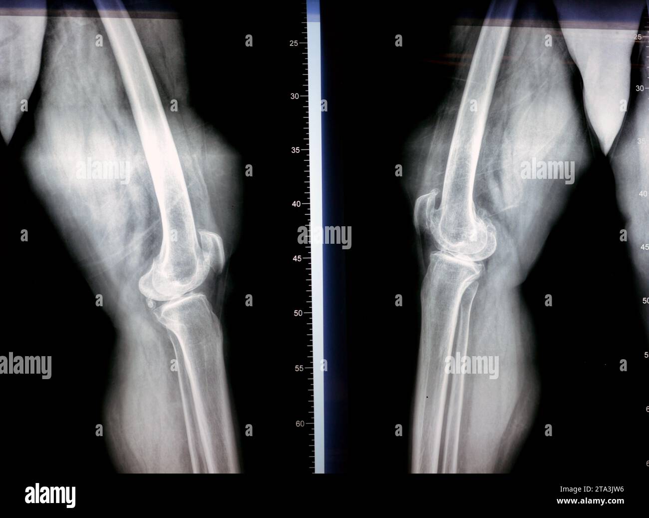 La radiographie simple des deux articulations du genou montre une ...