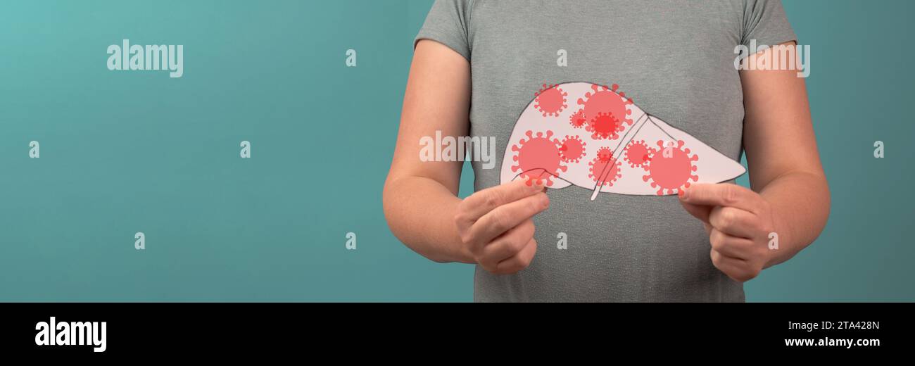 Organe du foie infecté par le virus, journée mondiale de l'hépatite ...
