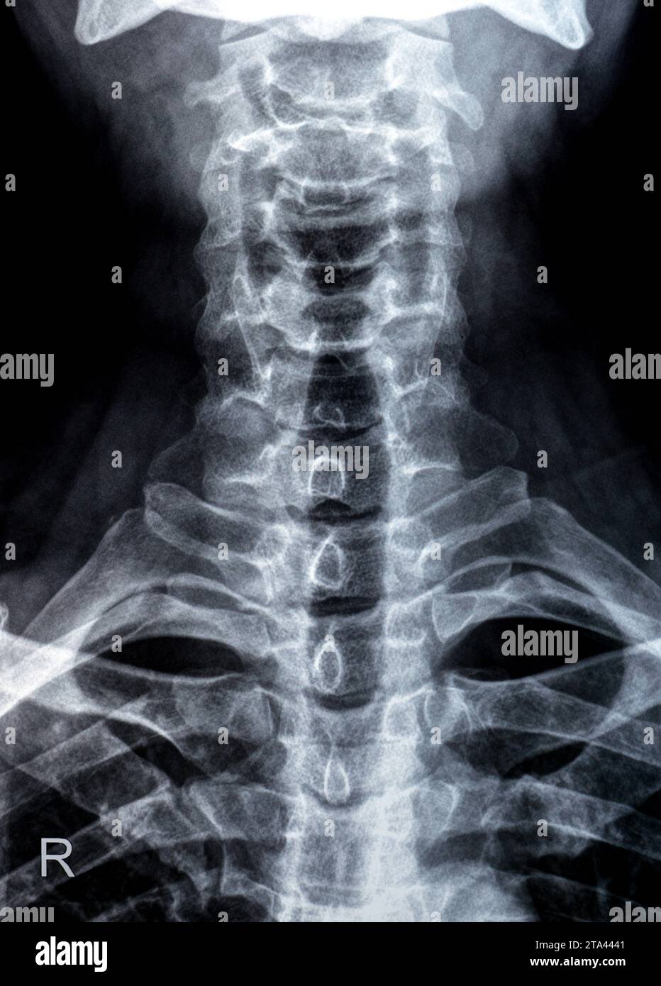 Une radiographie simple de la colonne cervicale a révélé une courbe ...