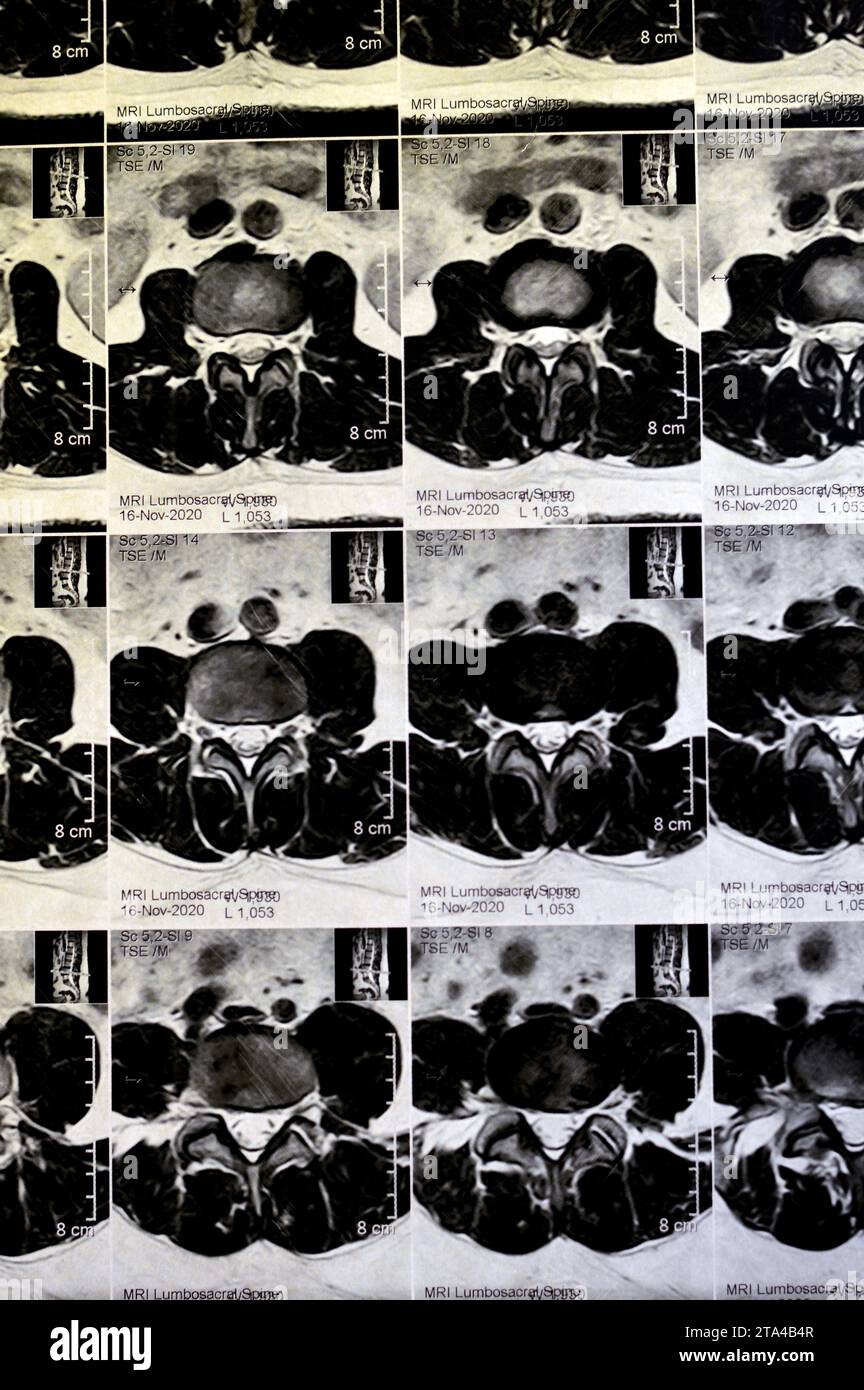 IRM rachis lombo-sacré sans produit de contraste a révélé un spasme ...