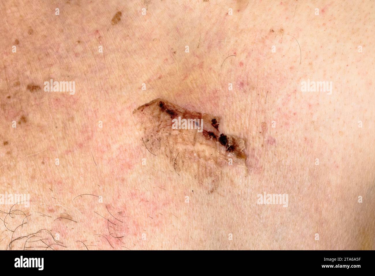 Cicatrice cardiaque Banque de photographies et d’images à haute ...