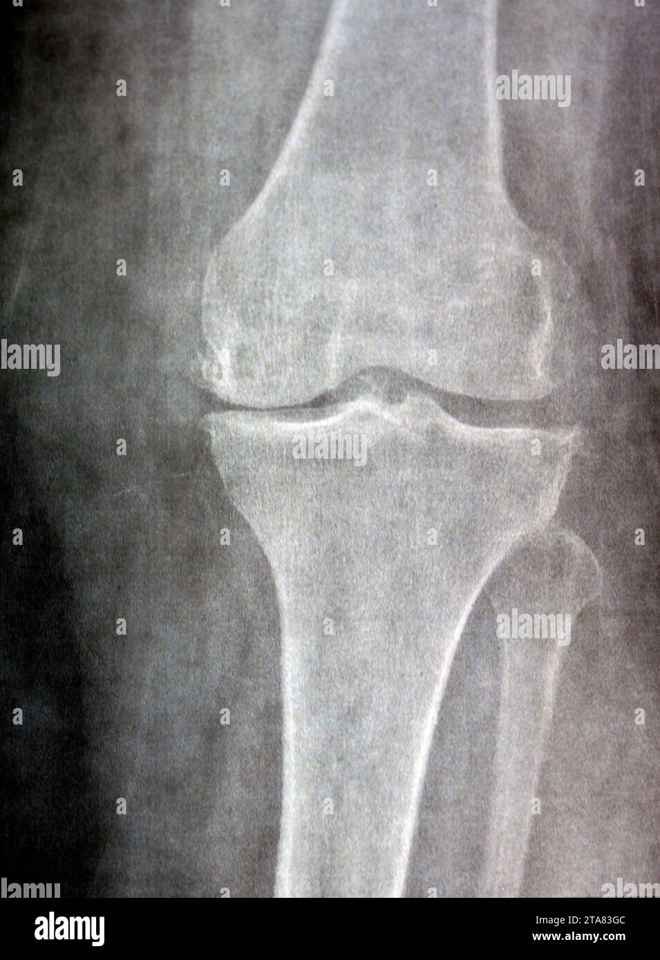 La radiographie simple du genou gauche montre une arthrose articulaire ...