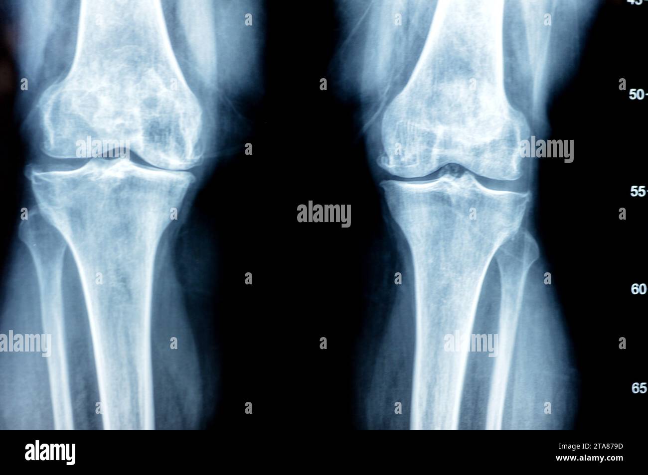 La radiographie simple des deux articulations du genou montre une ...
