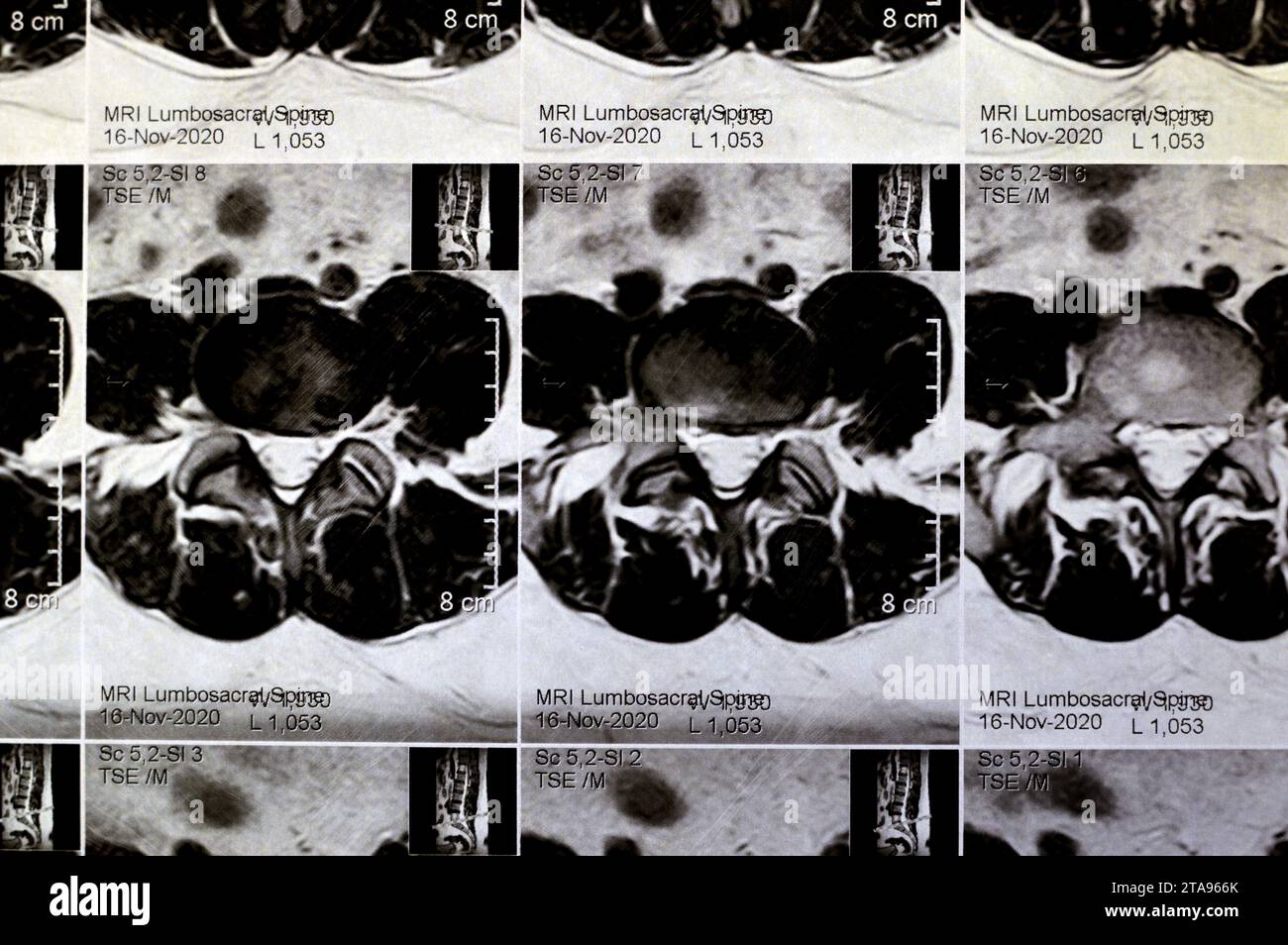 IRM rachis lombo-sacré sans produit de contraste a révélé un spasme ...