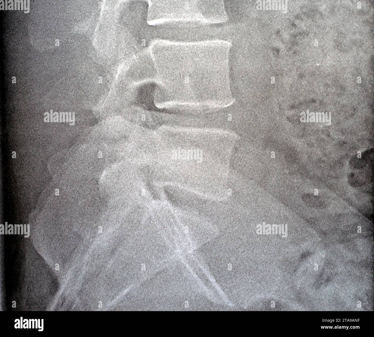 La radiographie simple du rachis lombo-sacré a révélé une légère déformation scoliotique ...