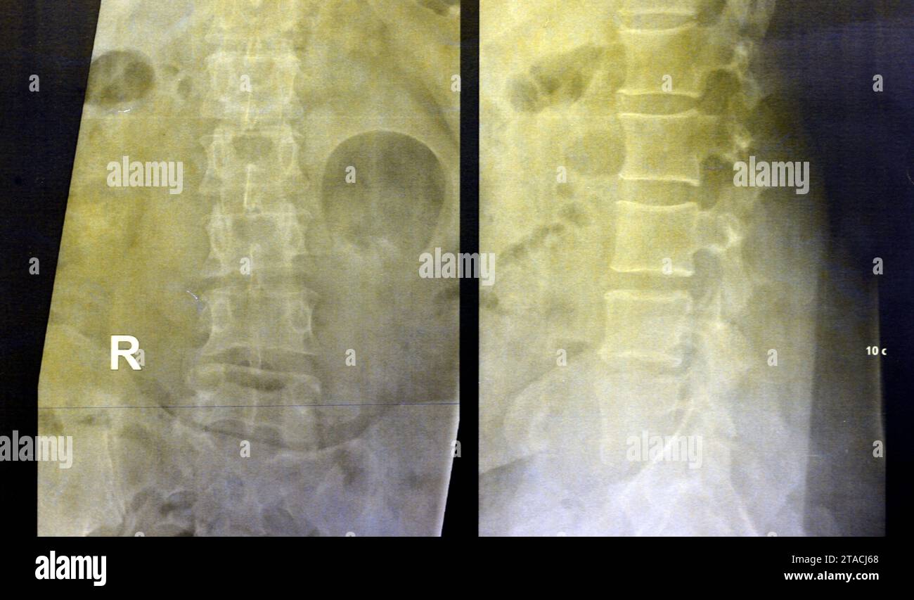 La radiographie simple du rachis lombo-sacré a révélé une légère ...