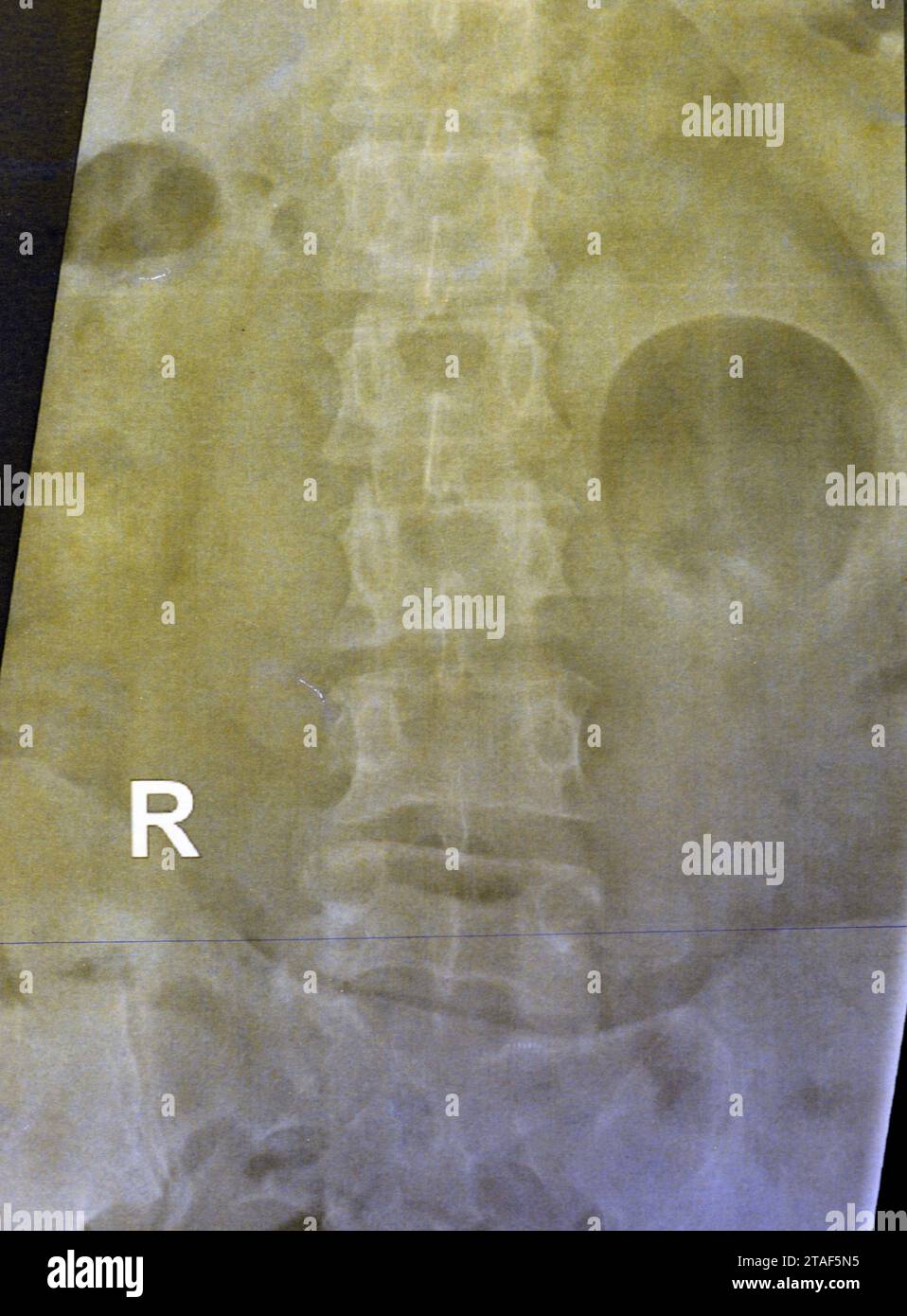 La radiographie simple du rachis lombo-sacré a révélé une légère ...