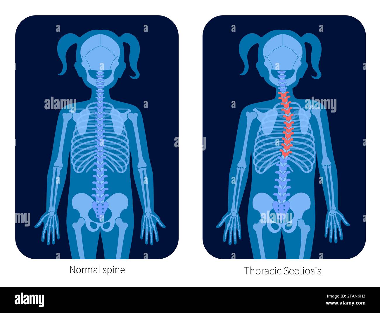 Scoliose thoracique Banque d'images détourées - Alamy