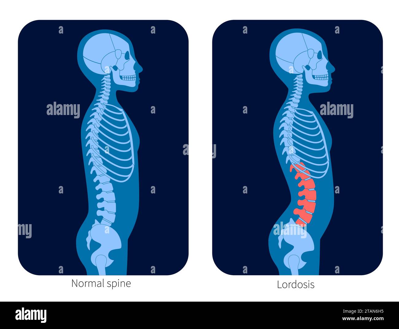 Posture scoliose lordose Banque d'images détourées - Alamy