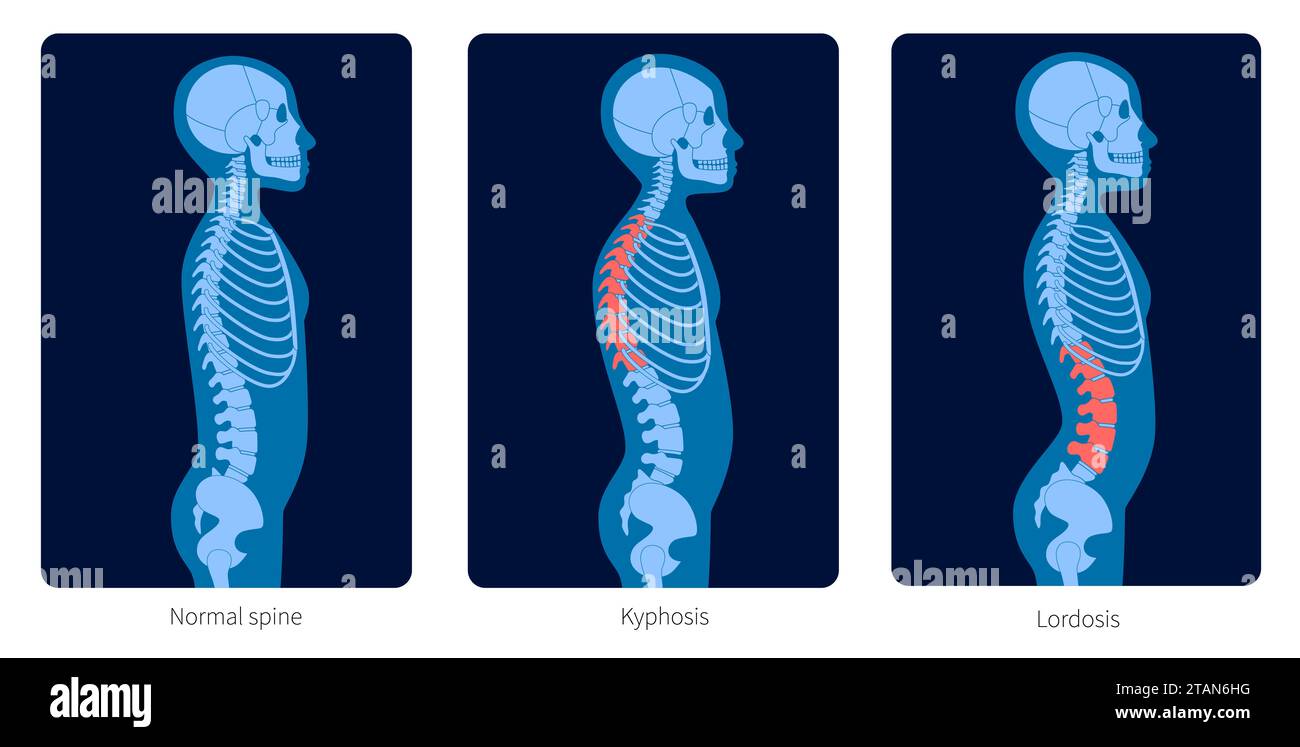 Lordose cervicale Banque de photographies et d’images à haute résolution - Alamy