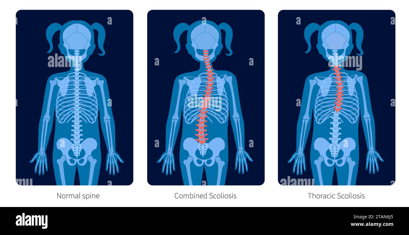 Scoliose thoracique Banque d'images détourées - Alamy
