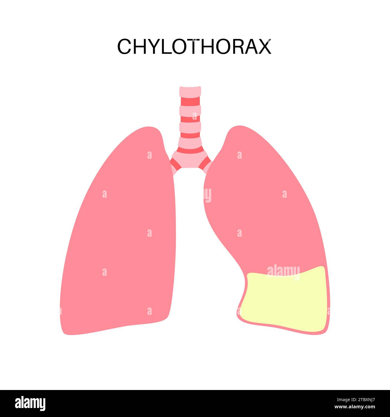 Pleural effusion Banque d'images détourées - Alamy