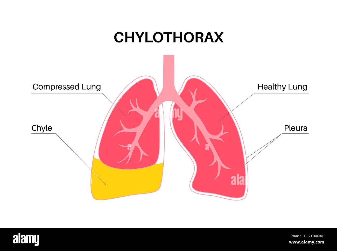 Pleural effusion Banque d'images détourées - Alamy