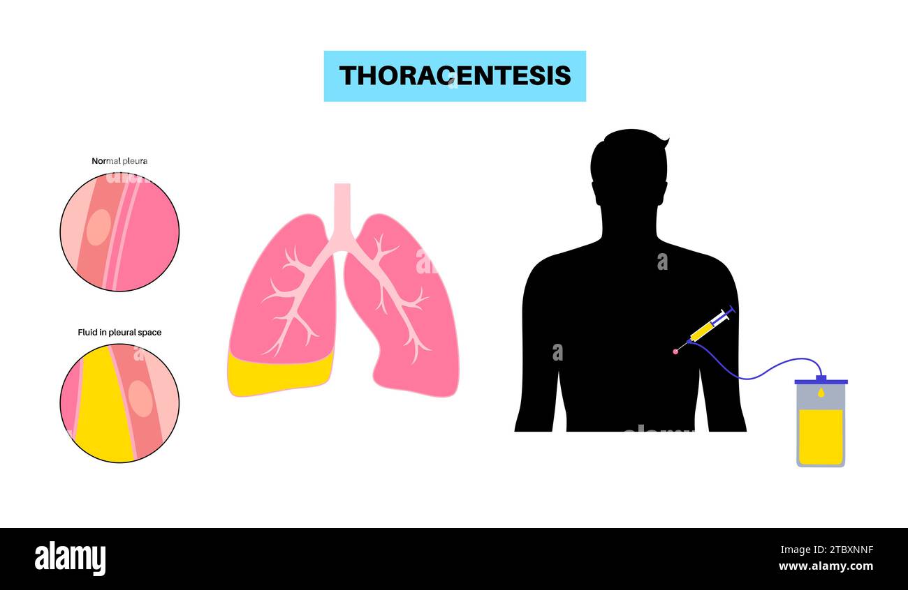 Pneumothorax et emphyseme Banque de photographies et d’images à haute ...