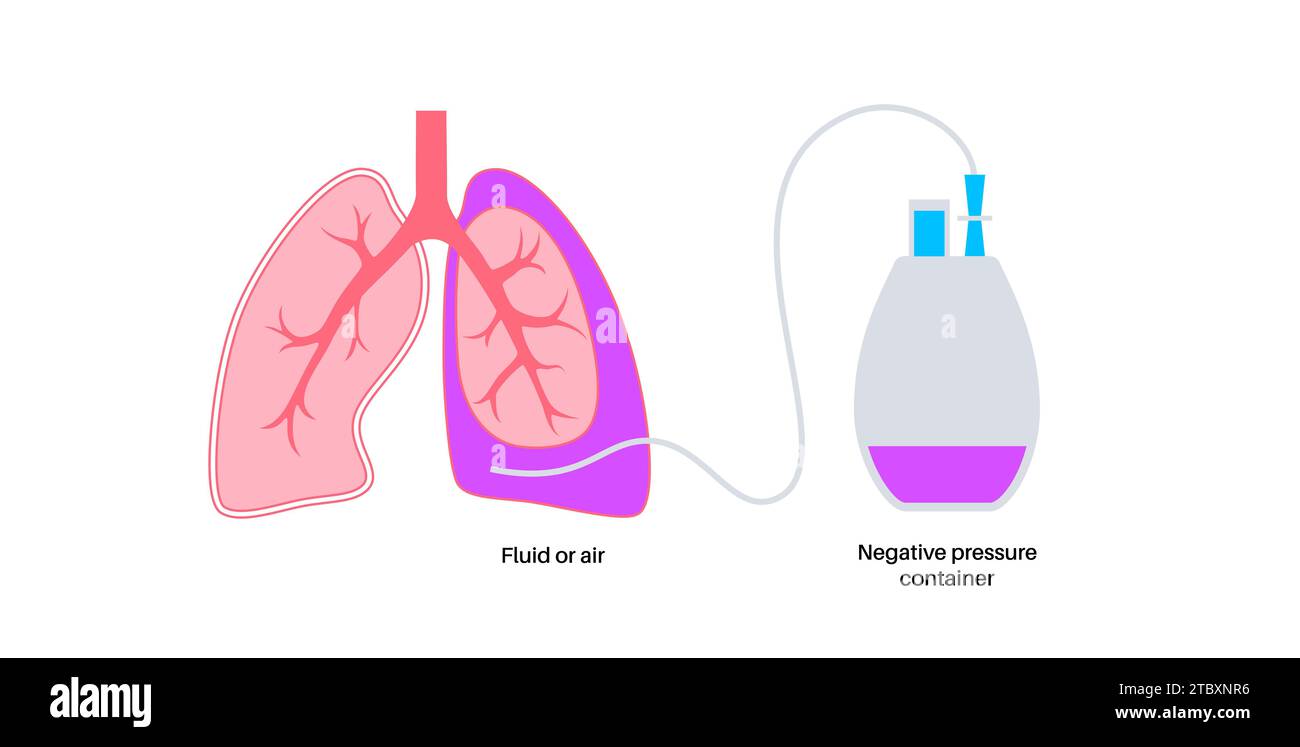 Pneumothorax et emphyseme Banque de photographies et d’images à haute ...