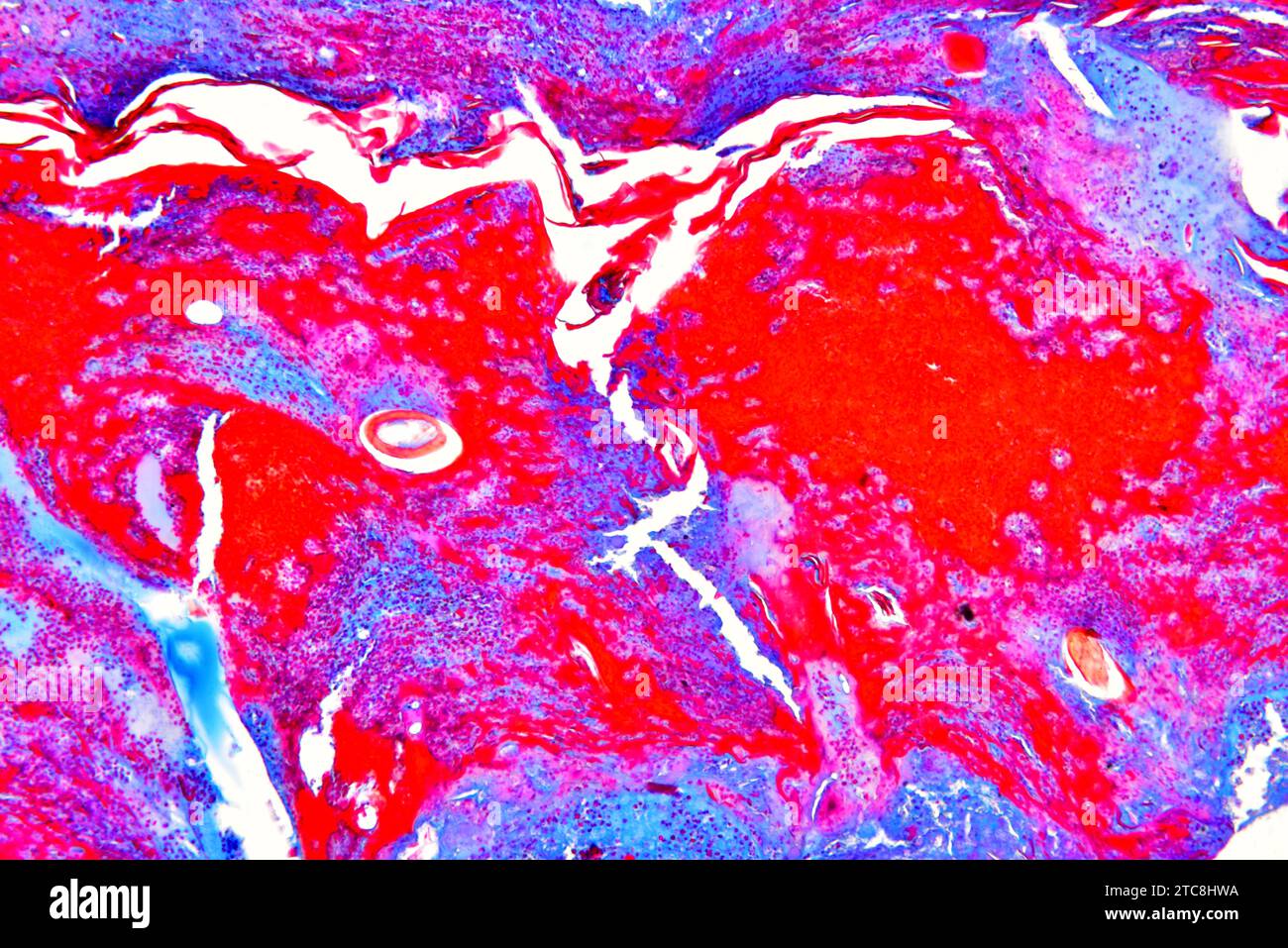 Peau humaine avec gale, produite par un acarien (Sarcoptes scabiei ...