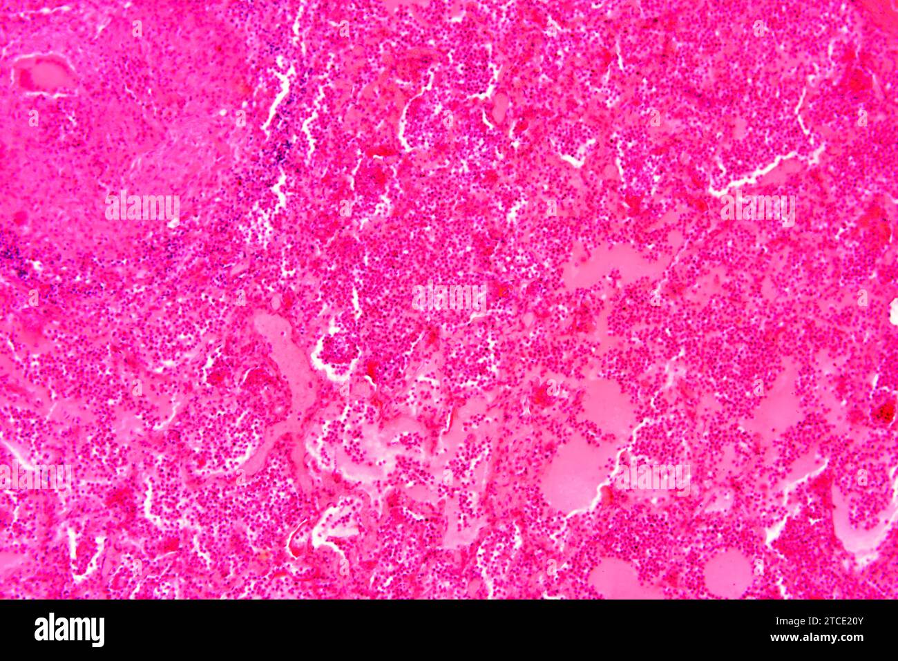 Section pulmonaire de la tuberculose humaine. Microscope optique X100 ...