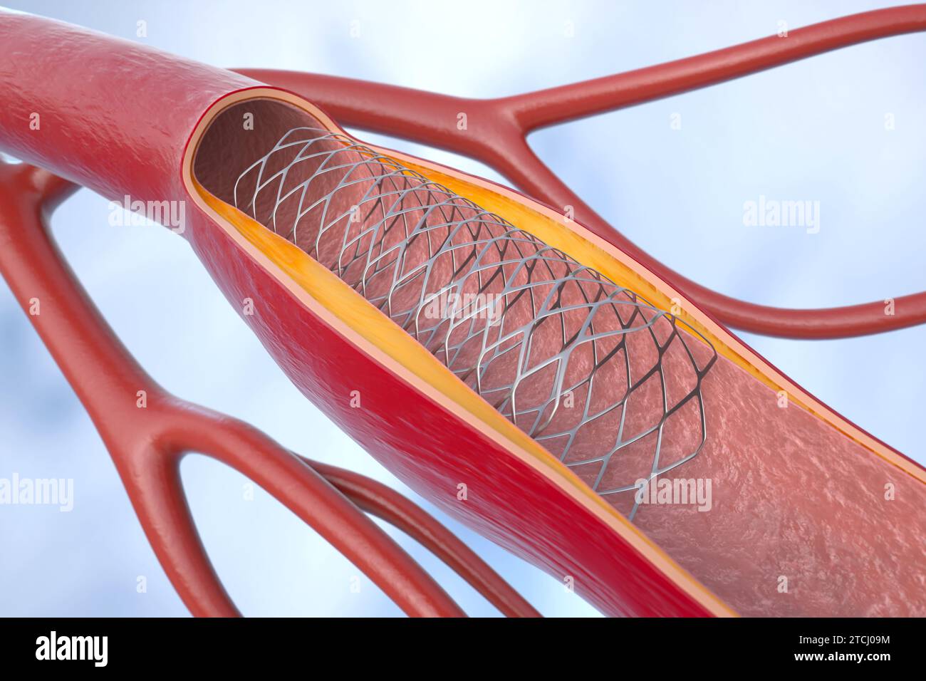 L'angioplastie coronaire avec pose d'endoprothèse (intervention coronaire percutanée ou ICP ...