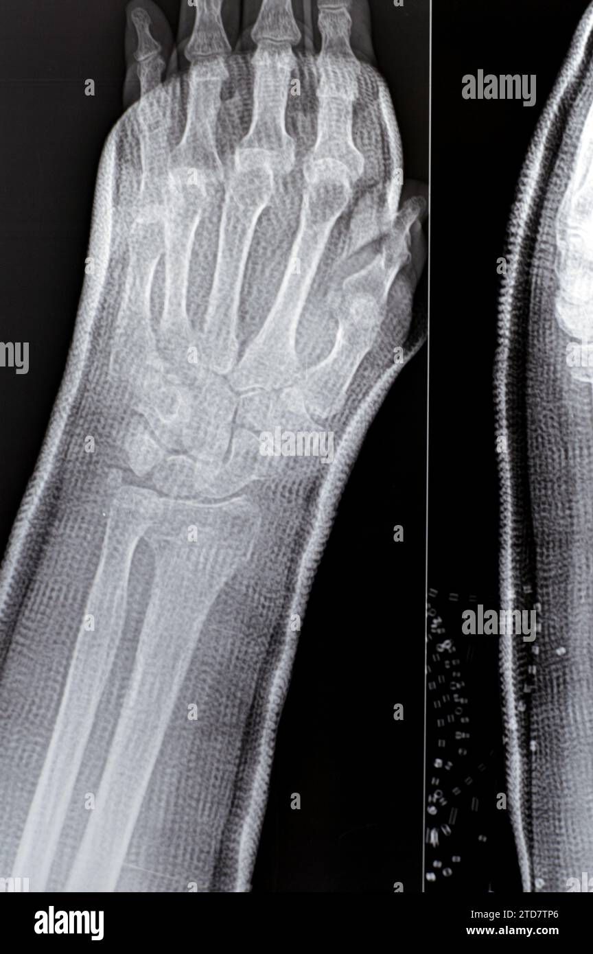 Réduction de fracture colles d'une vieille femelle, un type de fracture ...