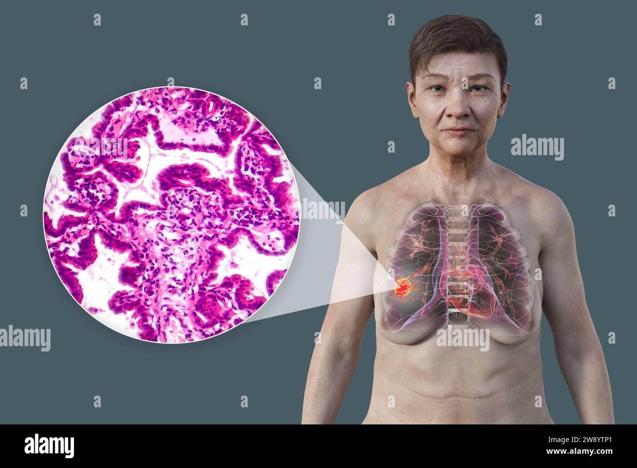 Cancer du poumon et micrographie optique Banque de photographies et d’images à haute résolution ...